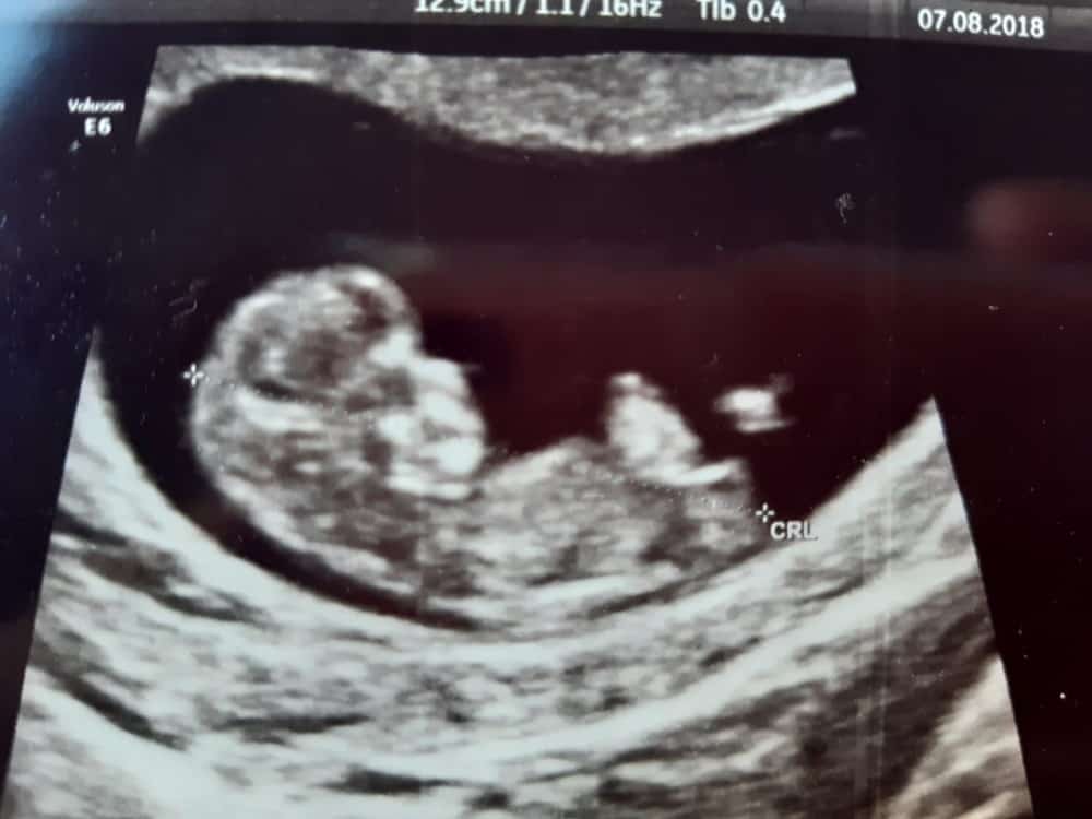 Zwangerschapsecho van de baby: kijkje in de zwangere buik