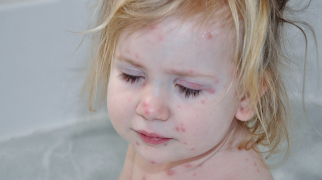 Waterpokken: symptomen en behandeling tegen jeuk