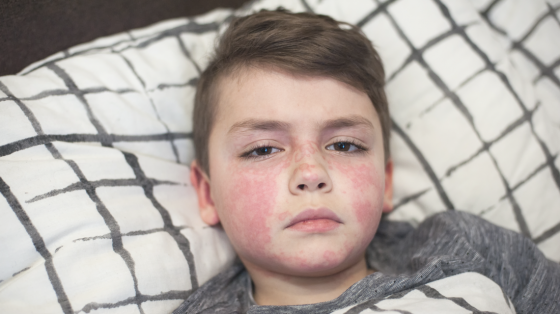 Roodvonk: oorzaak, klachten en behandeling