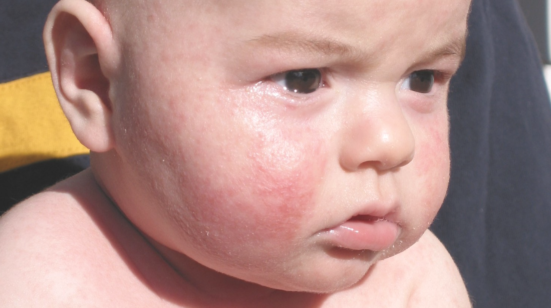 Vernauwde voorhuid bij je kind: wanneer bel je de dokter?